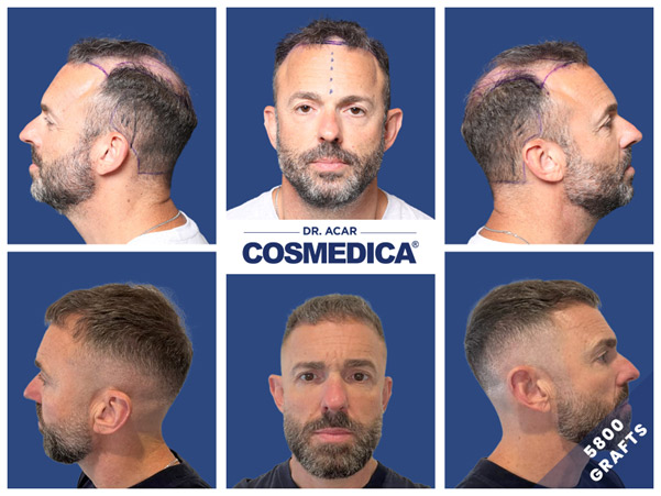 The 5 Best Hair Transplant Clinics in Turkey